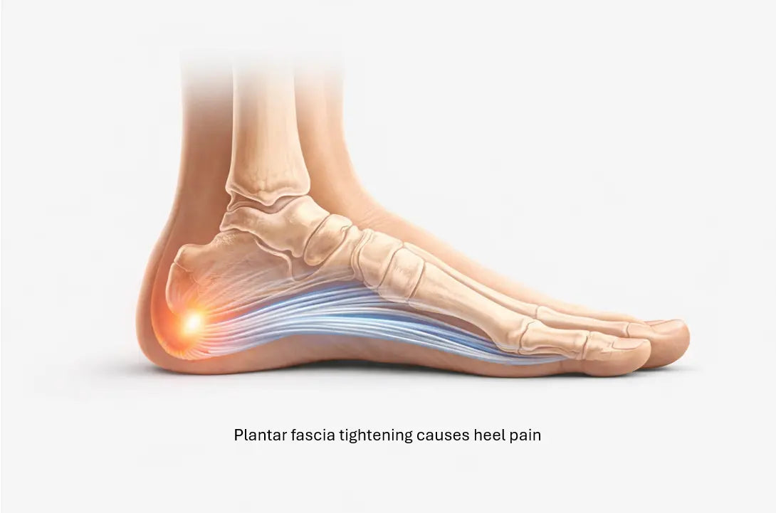 Understanding Symptoms of Plantar Fasciitis and Treatments ...